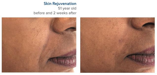 Beauty Lodge | Stem Cell Micro Needling Facial | Health and Beauty Clinic